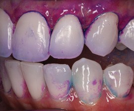 Tri plaque ID Gel