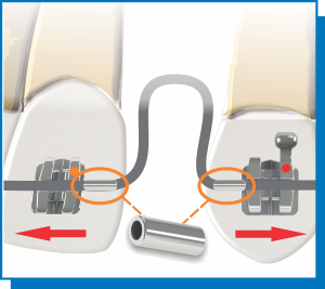 Stop para arcos redondos hasta .021"